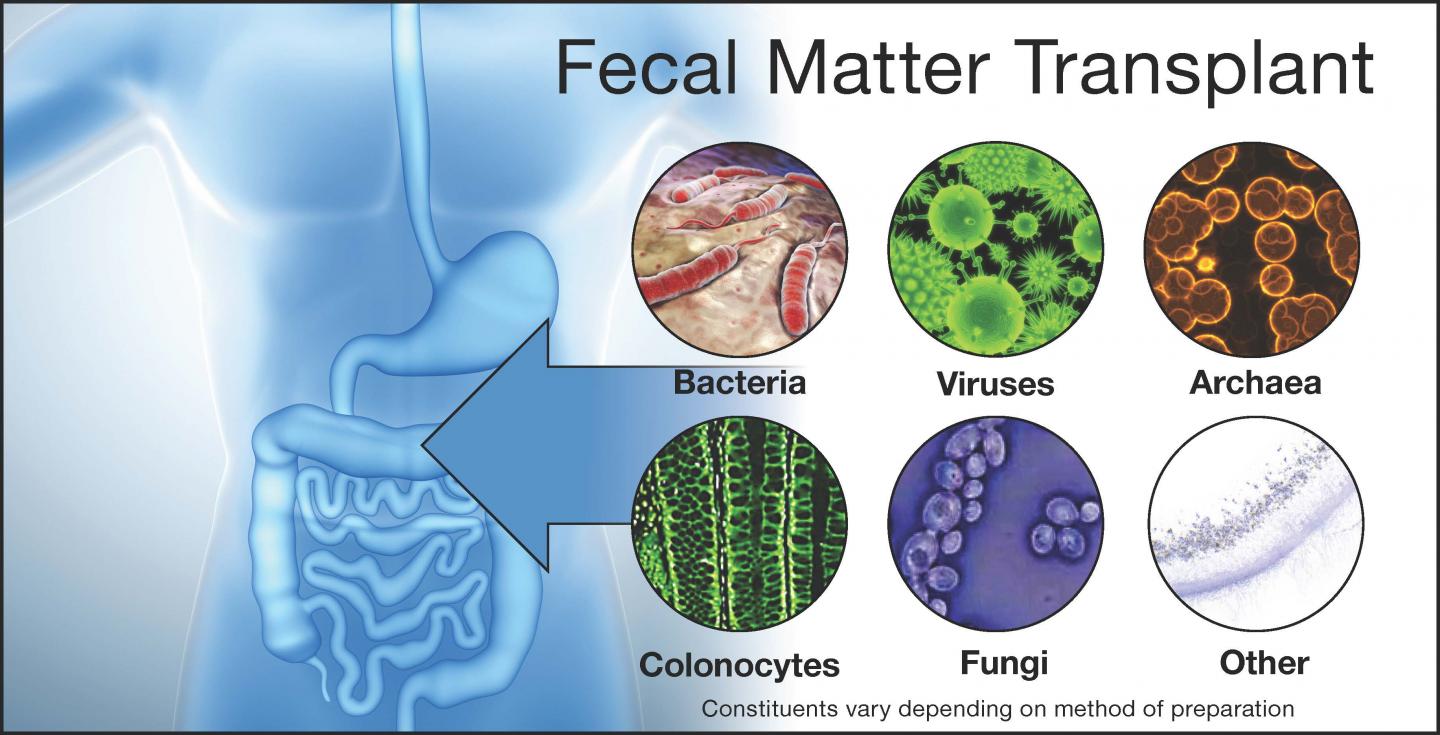 These Days Fecal Transplantation is No Joke - Drug Discovery and ...