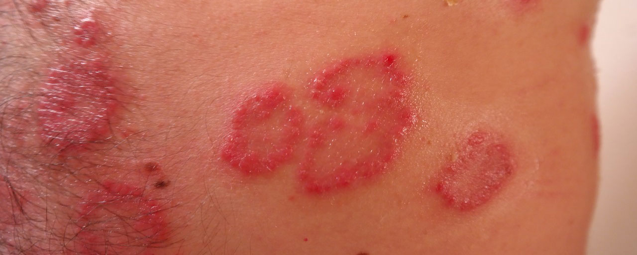 The FDA Approves UCB's Cimzia - Drug Discovery and Development